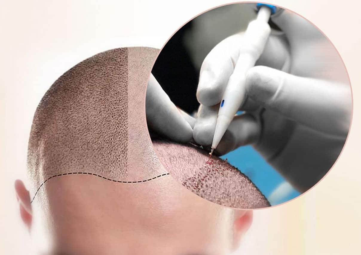 DHI Hair Transplant Explained - Hairline.com.au